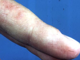 Stainless Hypoallergenic Needles - The Needle Lady